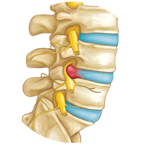 Top Spine Specialist in Mumbai, India | Synapse Spine