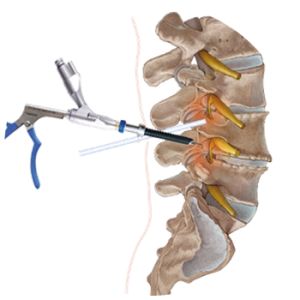 Top Spine Specialist in Mumbai, India | Synapse Spine