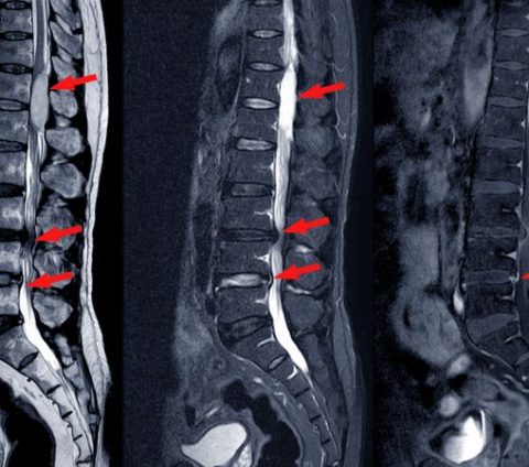 Lumbar Spine Stenosis Treatment In Mumbai | Synapse Spine